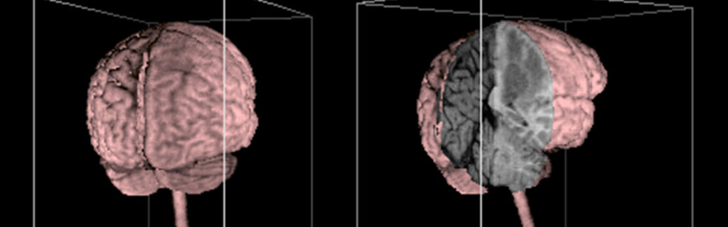 First 3D Reconstruction of the Brain from MRI