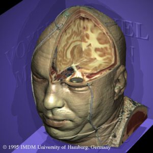 The Visible Human Project